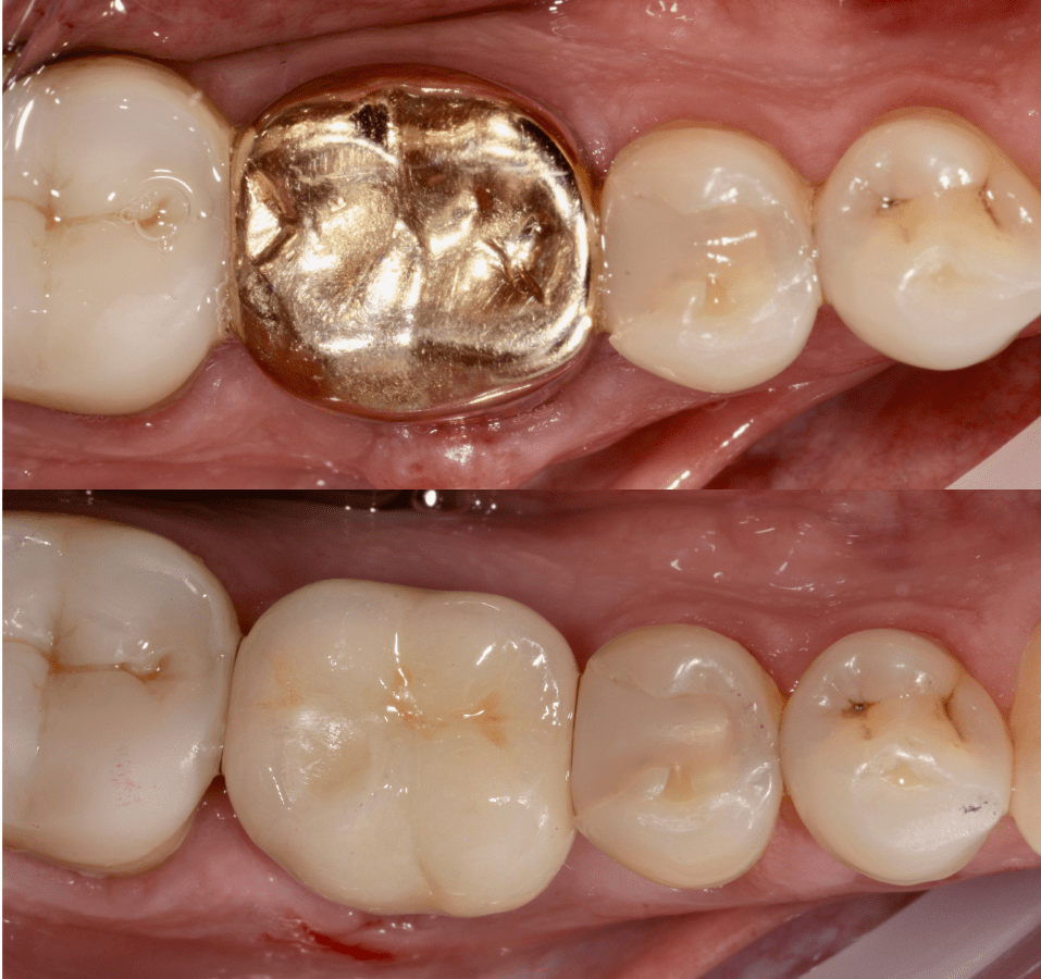 My Dental Crown Fell Out – What Should I Do? – Inverleith Dentalcare