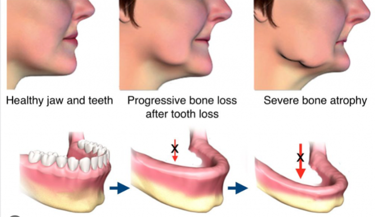 Mastering the Art of Eating with Loose Dentures – Inverleith Dentalcare